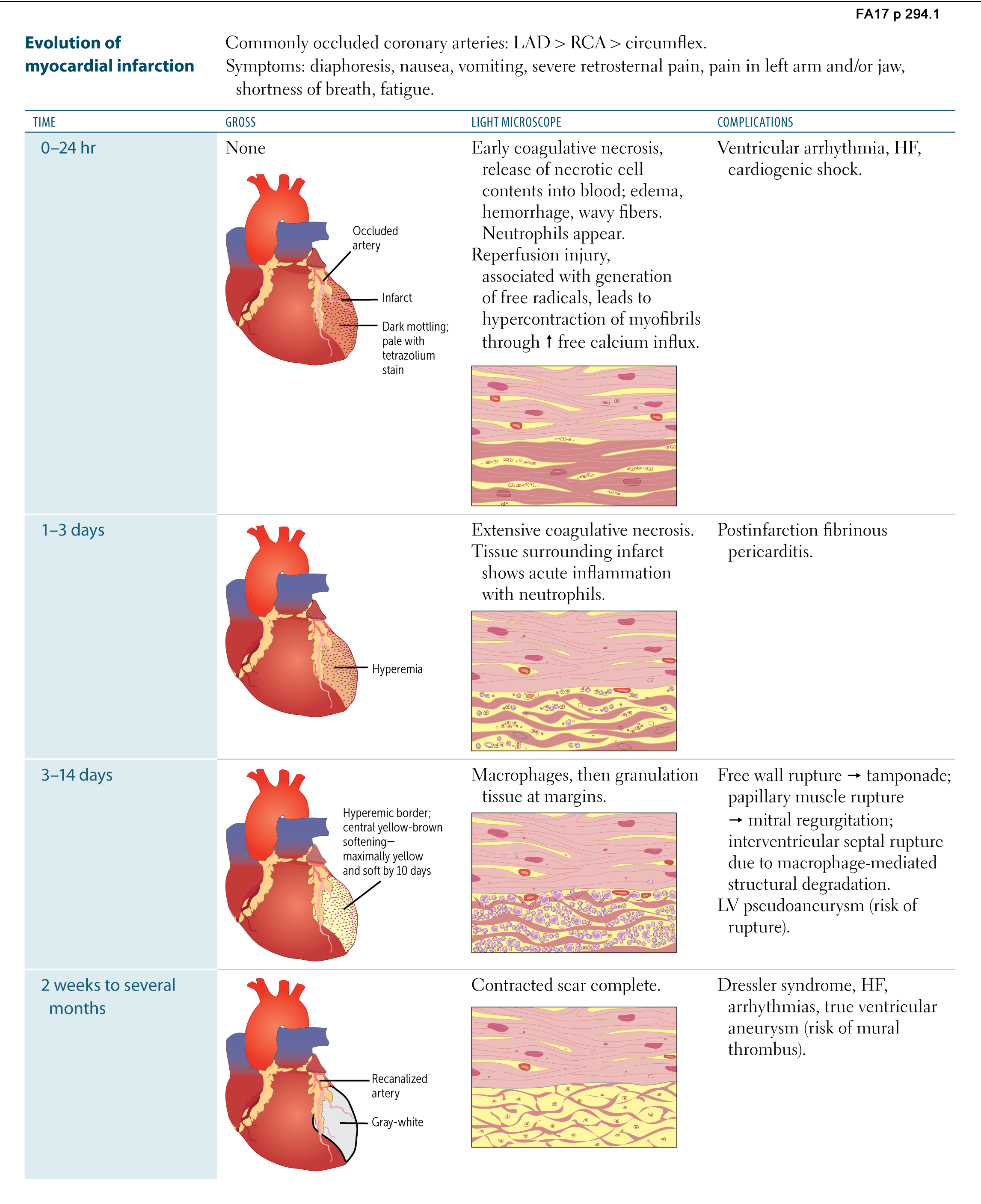 Myocardial Infarction Pathology