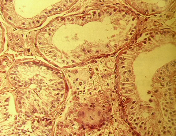Pathology Flashcards | Memorang
