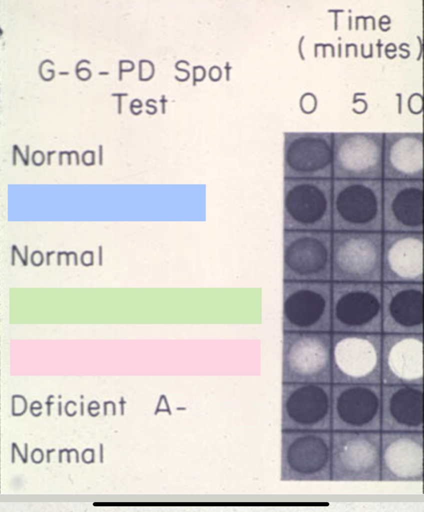 G6PD Deficiency Flashcards | Memorang