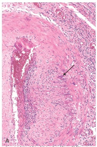 Vasculitis Flashcards Memorang