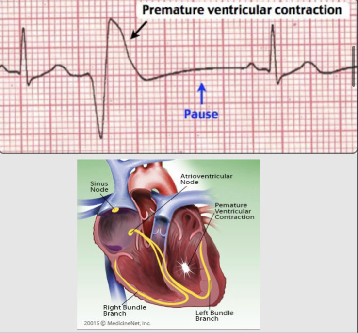 EKG Flashcards | Memorang