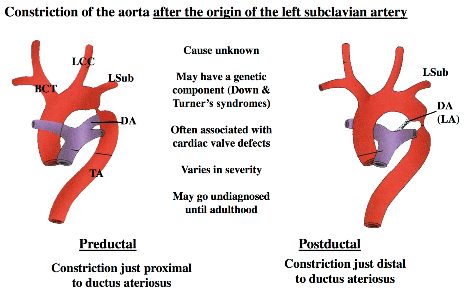 Preductal Coarctation Of Aorta