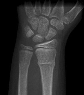 Childhood Musculoskeletal Conditions and Pediatric Fractures Flashcards ...