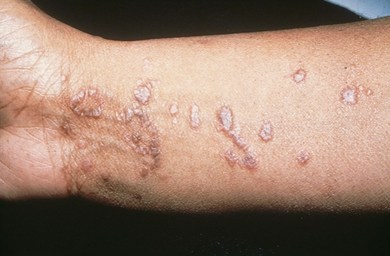 Dermatology Flashcards | Memorang