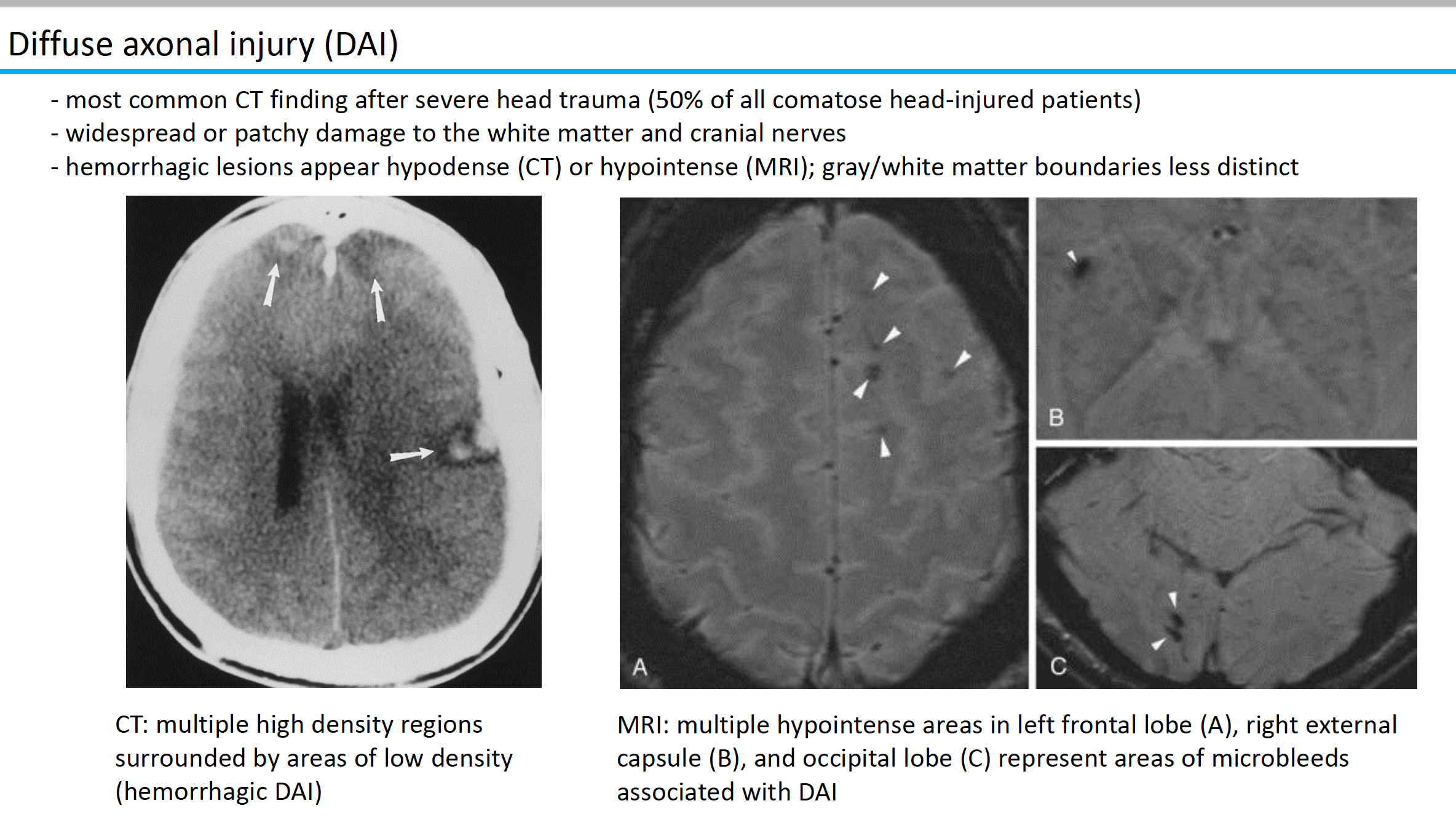 Diffuse Axonal Injury Gross