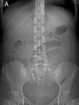 Abdomen Flashcards | Memorang