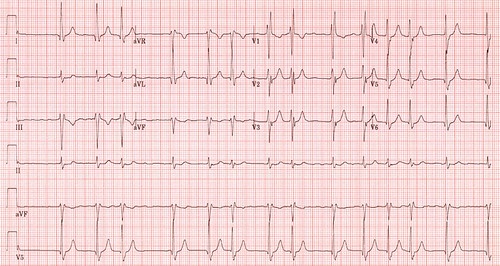 Arrhythmia Flashcards | Memorang
