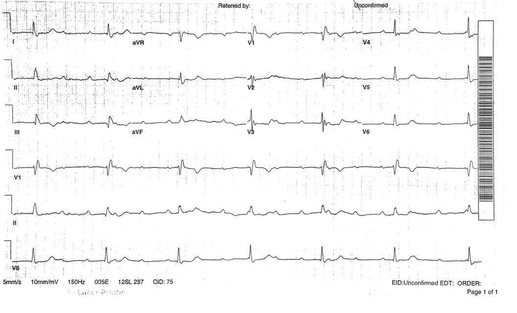 Bradyarrhythmias Flashcards | Memorang