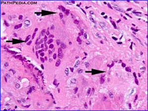 Vasculitis Flashcards Memorang