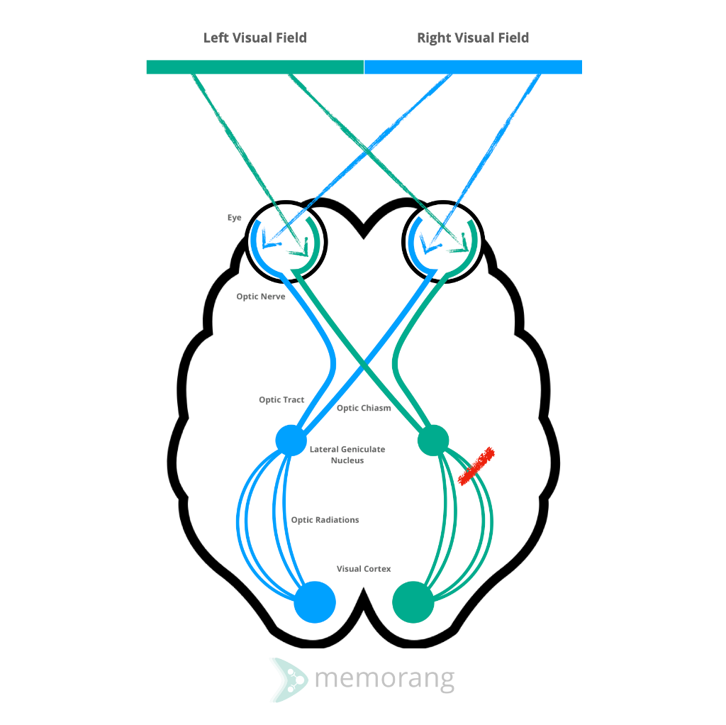 Visual Field Defects Flashcards | Memorang