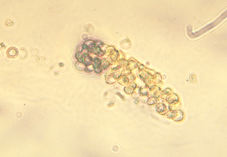 urinalysis Flashcards | Memorang
