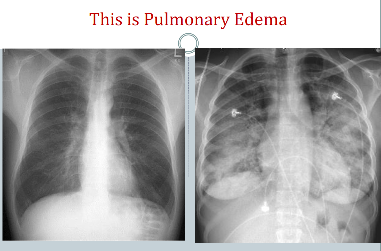 Alveolar Pulmonary Edema Icd 10