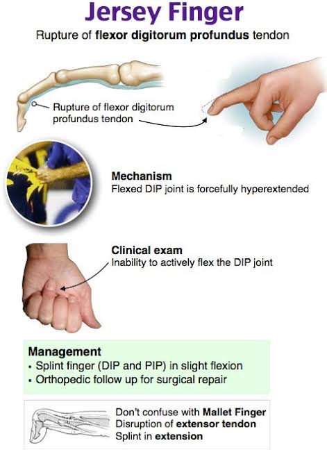 Flexor Digitorum Profundus Test