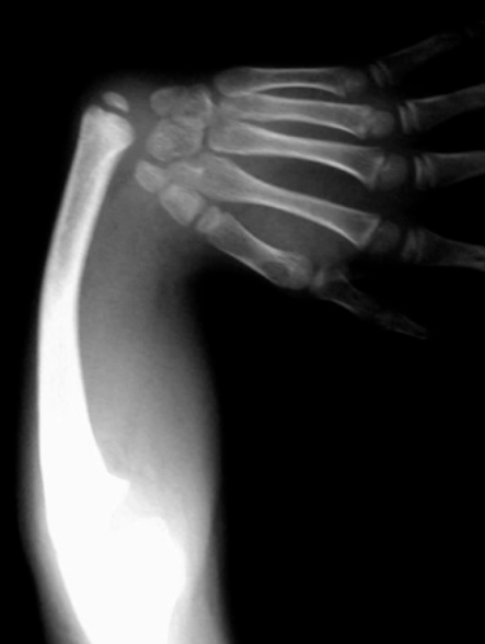 Congenital hand deformities Flashcards | Memorang