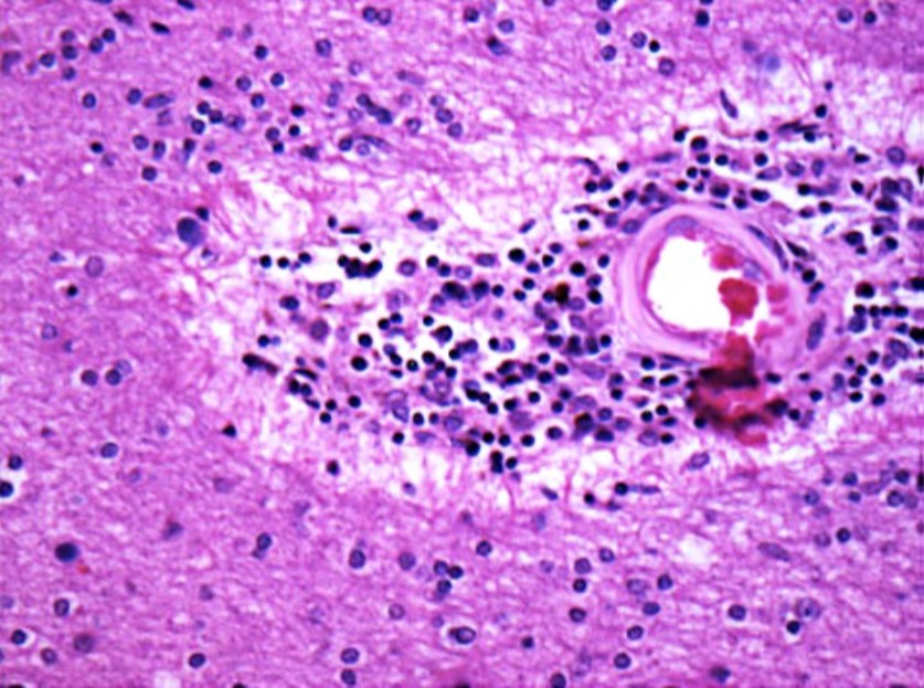 Neurosyphilis Histology