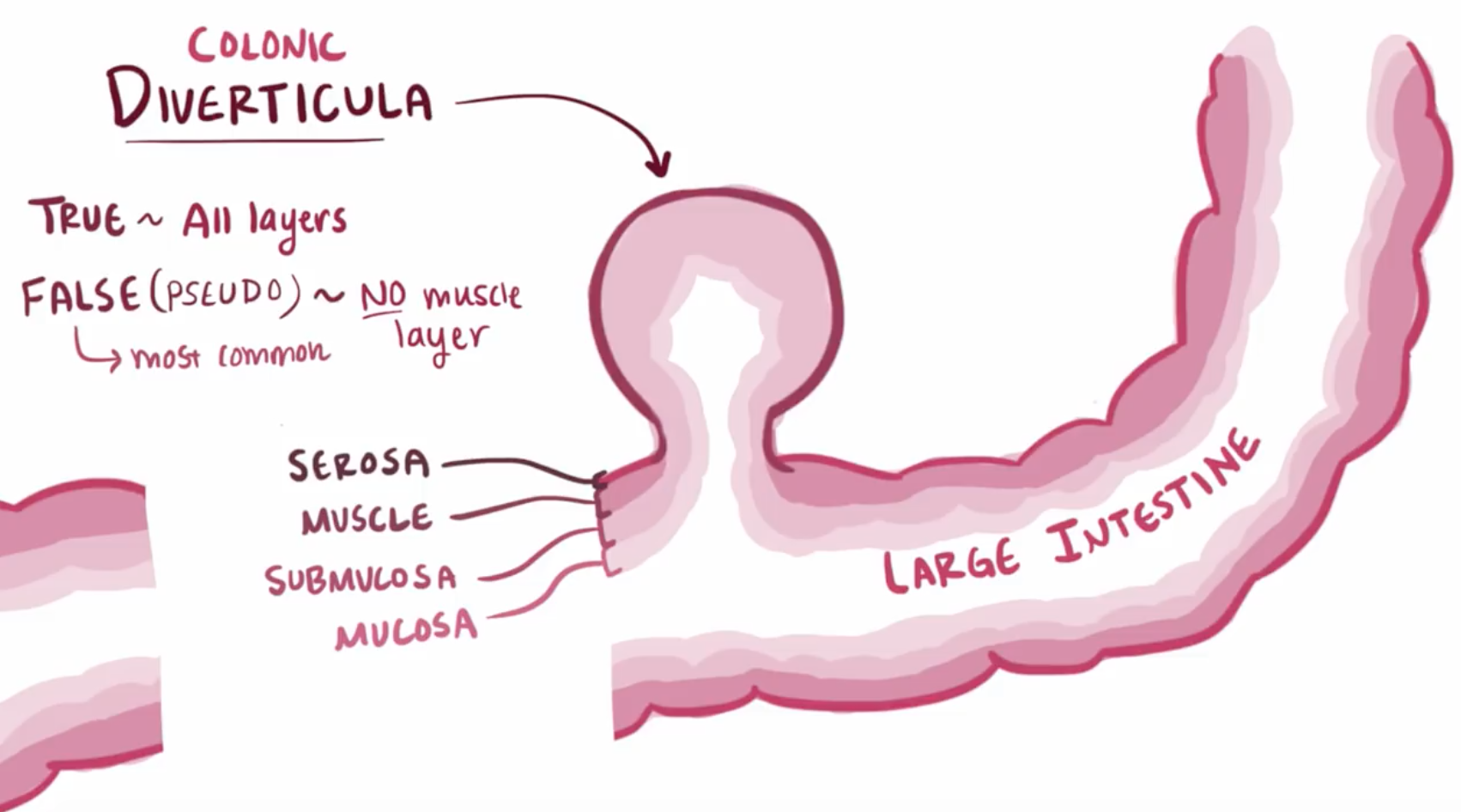 Diverticulosis/Diverticulitis Flashcards | Memorang