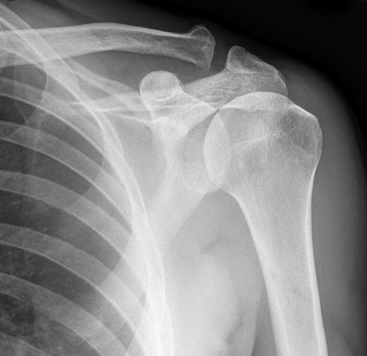 Shoulder Anatomy Flashcards | Memorang