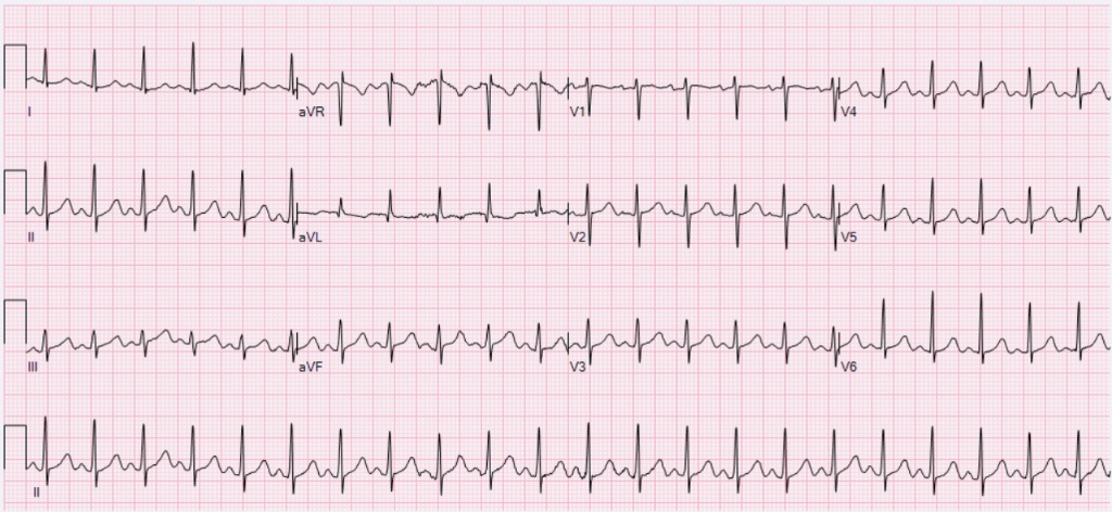 Visual Diagnosis: EKGs Flashcards | Memorang