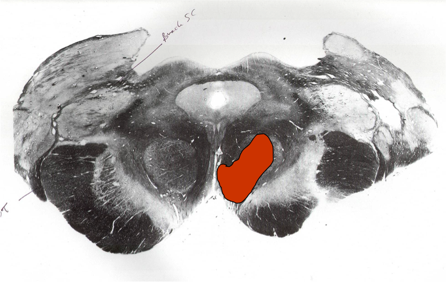 Lesions Flashcards | Memorang