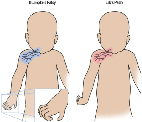 Erbs vs Klumpke's Palsy Flashcards | Memorang