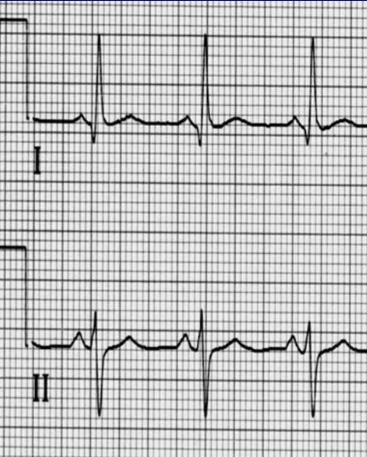 EKG Flashcards | Memorang
