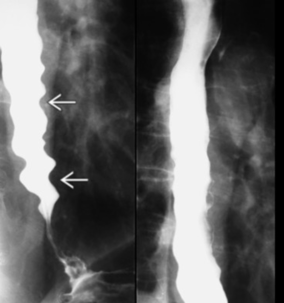 Esophagus Flashcards | Memorang