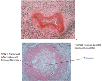 Vasculitis Flashcards | Memorang