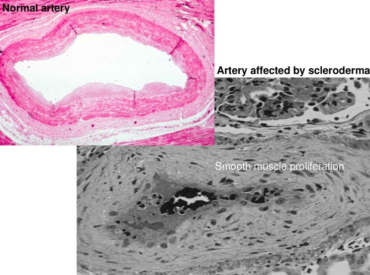 Scleroderma Flashcards | Memorang