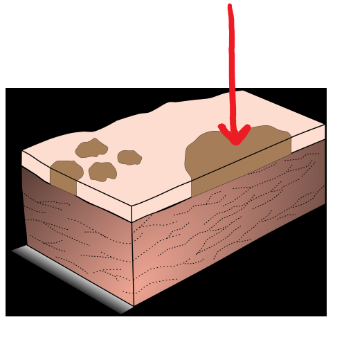 Derm Flashcards | Memorang