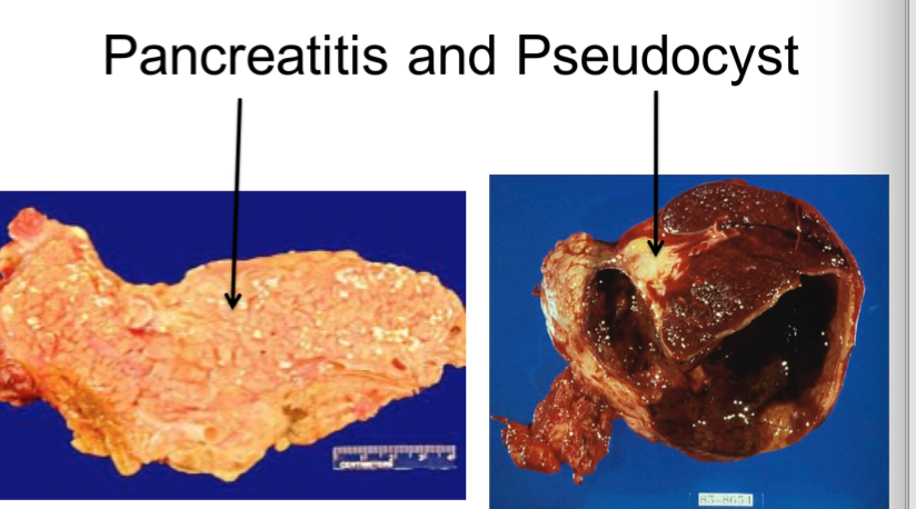 Pancreatic Pseudocyst Gross