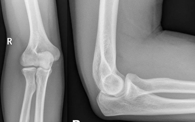 Elbow Anatomy Flashcards | Memorang