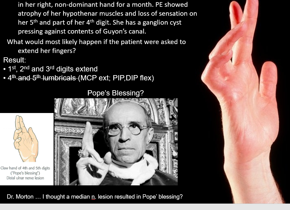 Popes Blessing Median Nerve