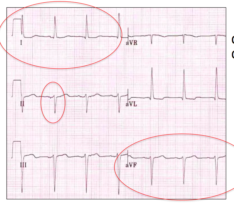 ECG Flashcards | Memorang