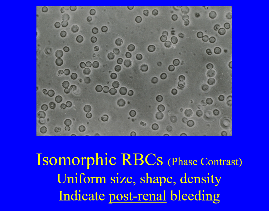urinalysis Flashcards | Memorang
