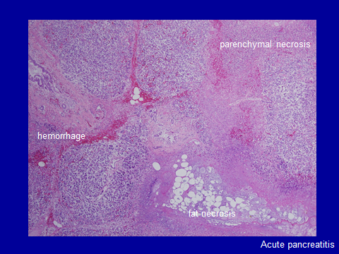 Fat Necrosis Pancreas Pathology Outlines