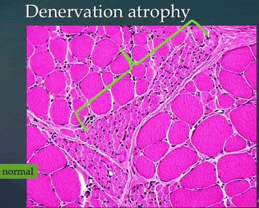 Pathology Flashcards | Memorang