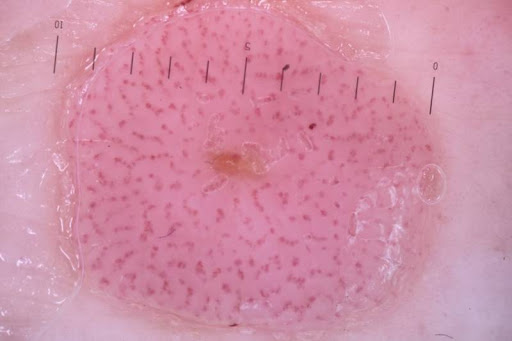 Dermoscopy Flashcards | Memorang