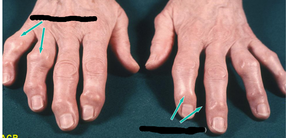 Osteoarthritis Flashcards | Memorang