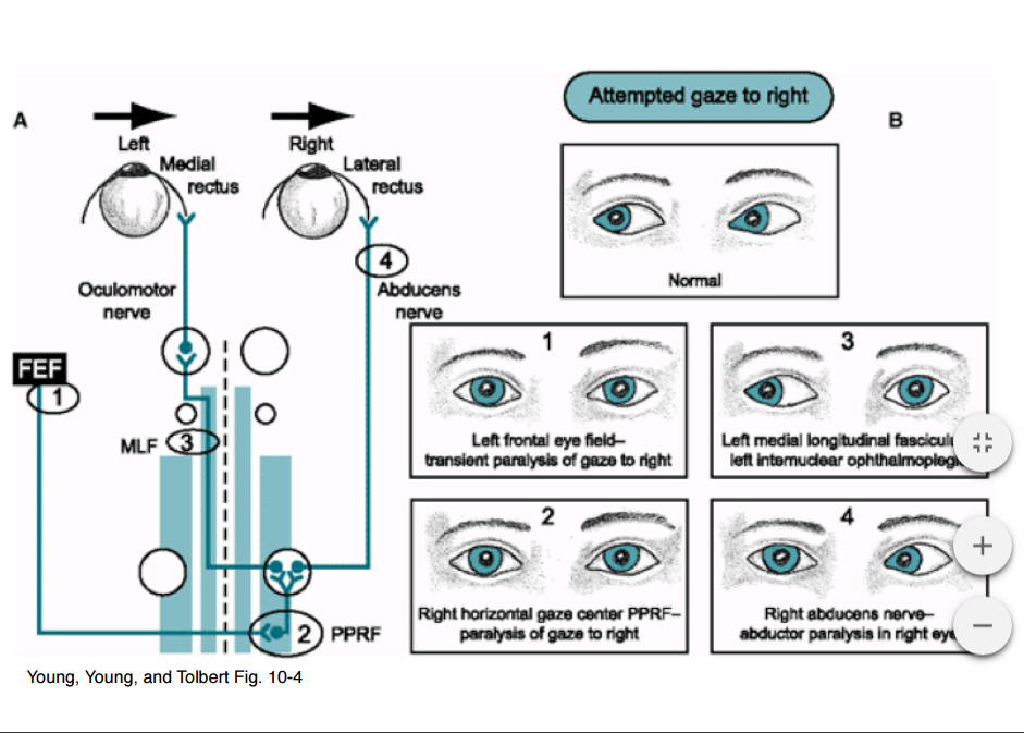 Paramedian Pontine Reticular Formation Lesion