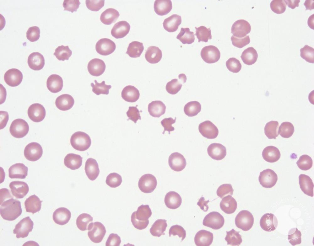 Visual Diagnosis: Hematologic Pathologies Flashcards | Memorang Visual Diagnosis: Hematologic Pathologies Flashcards | Memorang