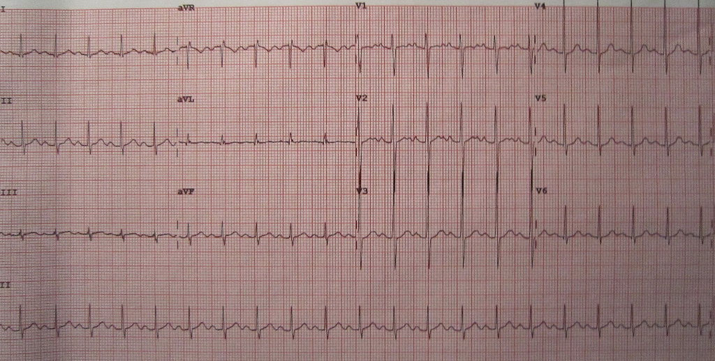 Visual Diagnosis: EKGs Flashcards | Memorang
