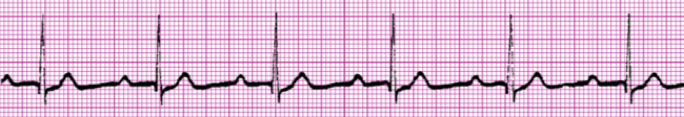 ACLS Flashcards | Memorang