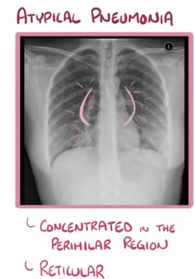 Pneumonia Flashcards | Memorang