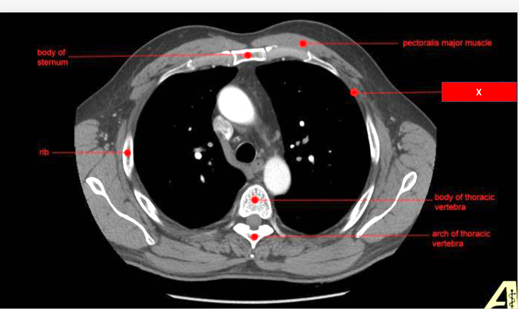 Thorax Radiologic Anatomy