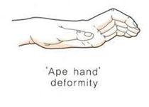 Common hand and finger deformities Flashcards | Memorang