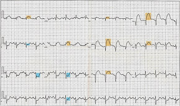 Visual Diagnosis: EKGs Flashcards | Memorang