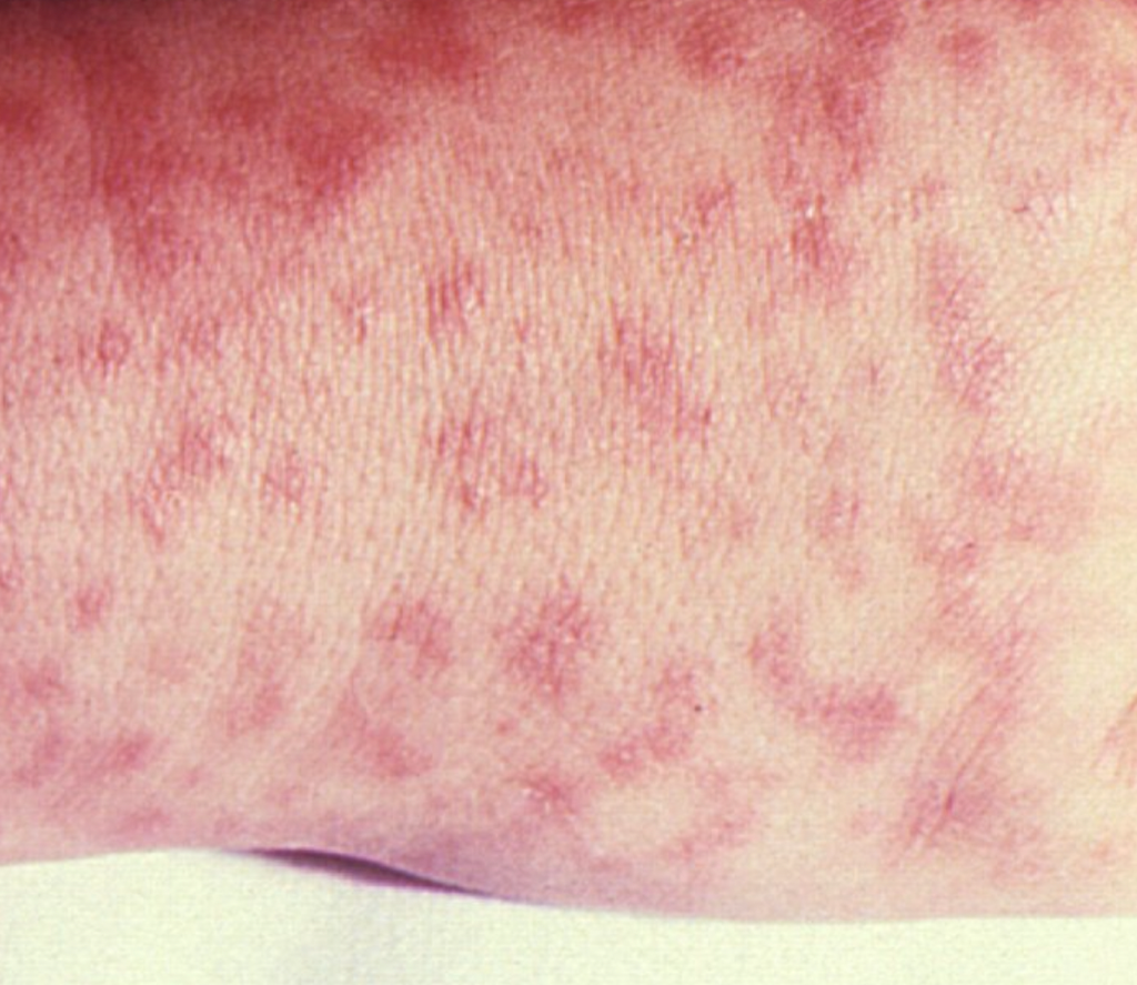 Vector Borne illness Flashcards | Memorang