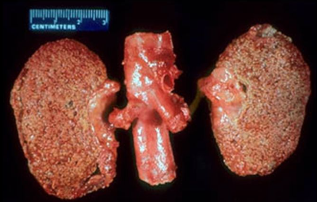 Renal | Pathology Images Flashcards | Memorang
