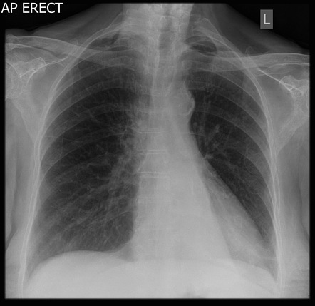 Normal Anatomy and Atelectasis Flashcards | Memorang