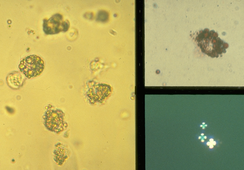 urinalysis Flashcards | Memorang
